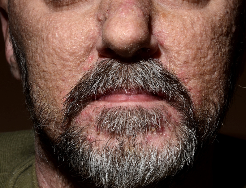 Dermatology for Primary Care Physicians